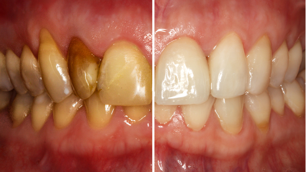Is Soda Bad For Your Teeth? | Dental Risks and Solutions