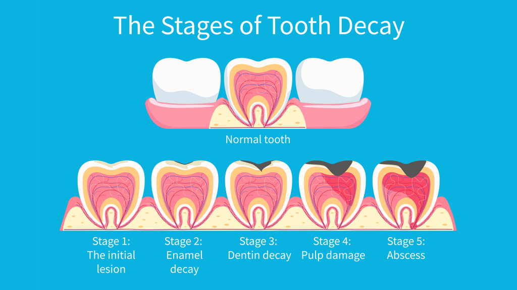 Is Soda Bad For Your Teeth? | Dental Risks and Solutions