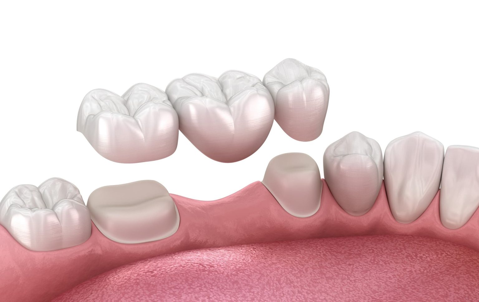 Permanent Dental Bridge Problems | Causes & Solutions