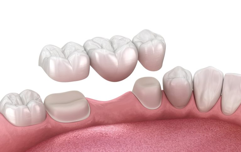 Permanent Dental Bridge Problems | Causes & Solutions